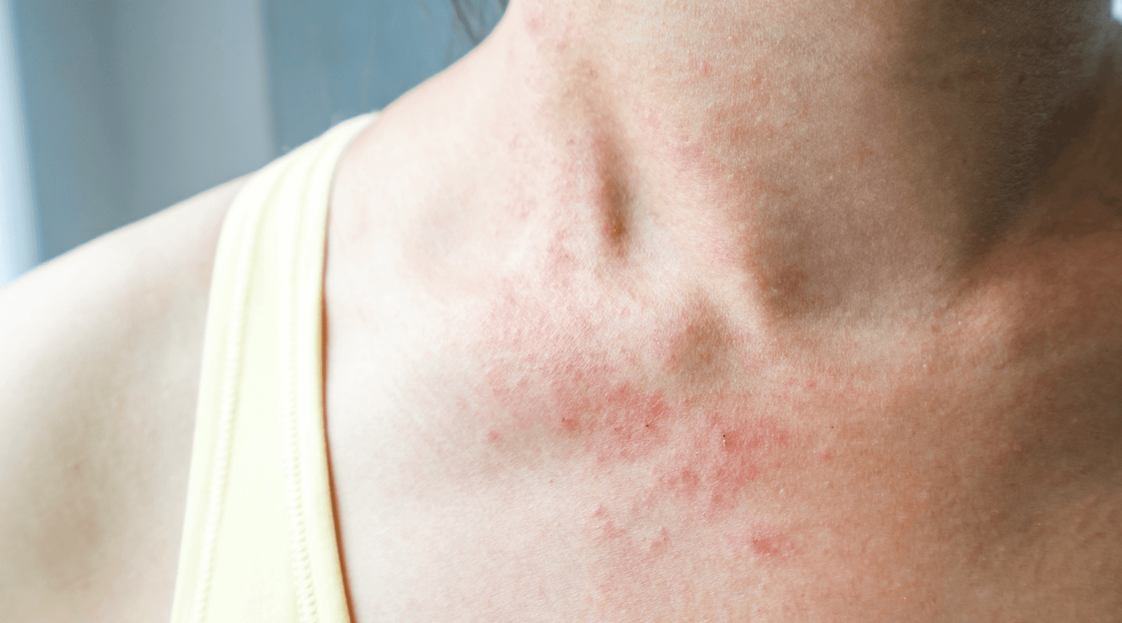Histamines and Skin Conditions – Hanna Sillitoe